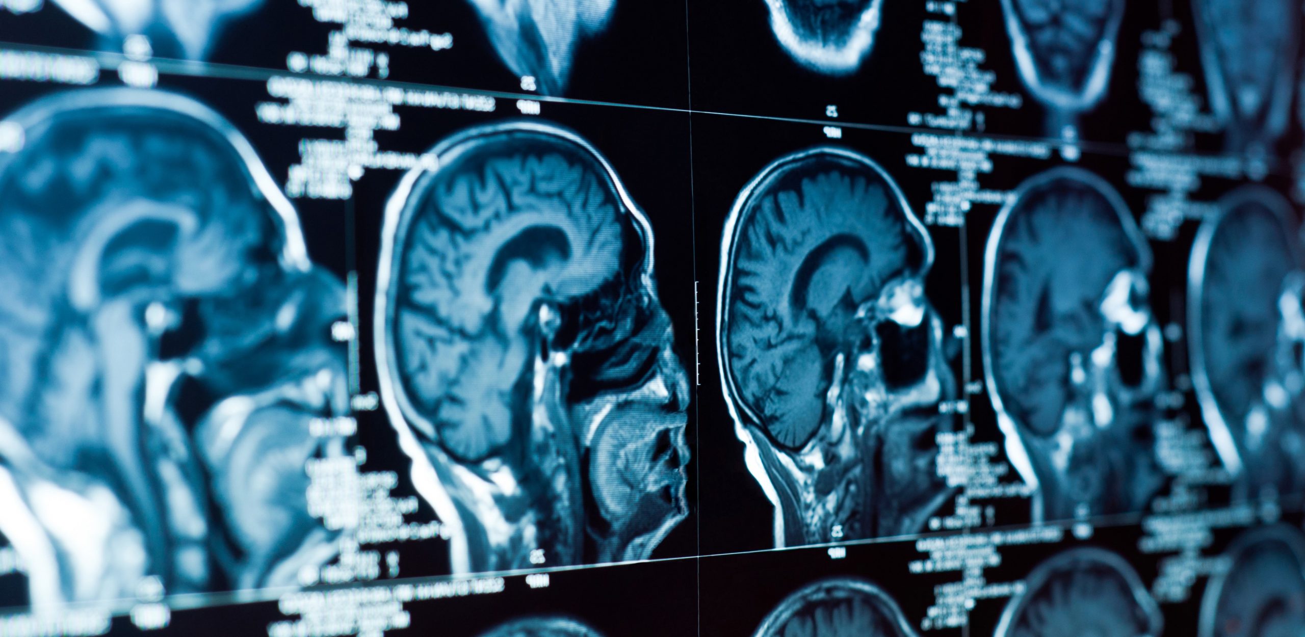 Neuroradiology - Newcastle Hospitals NHS Foundation Trust