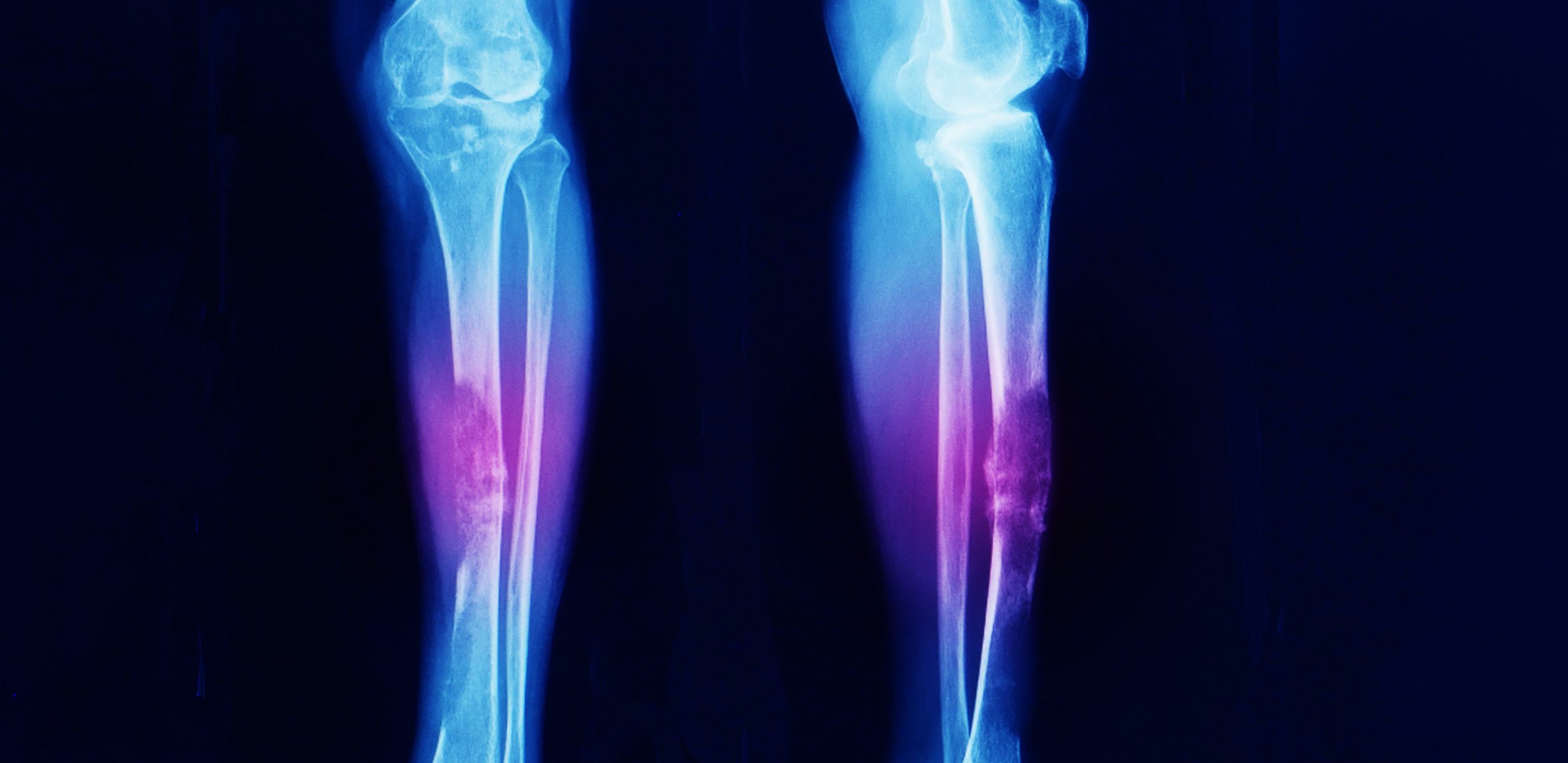 Bone and soft tissue tumour service - Newcastle Hospitals NHS ...