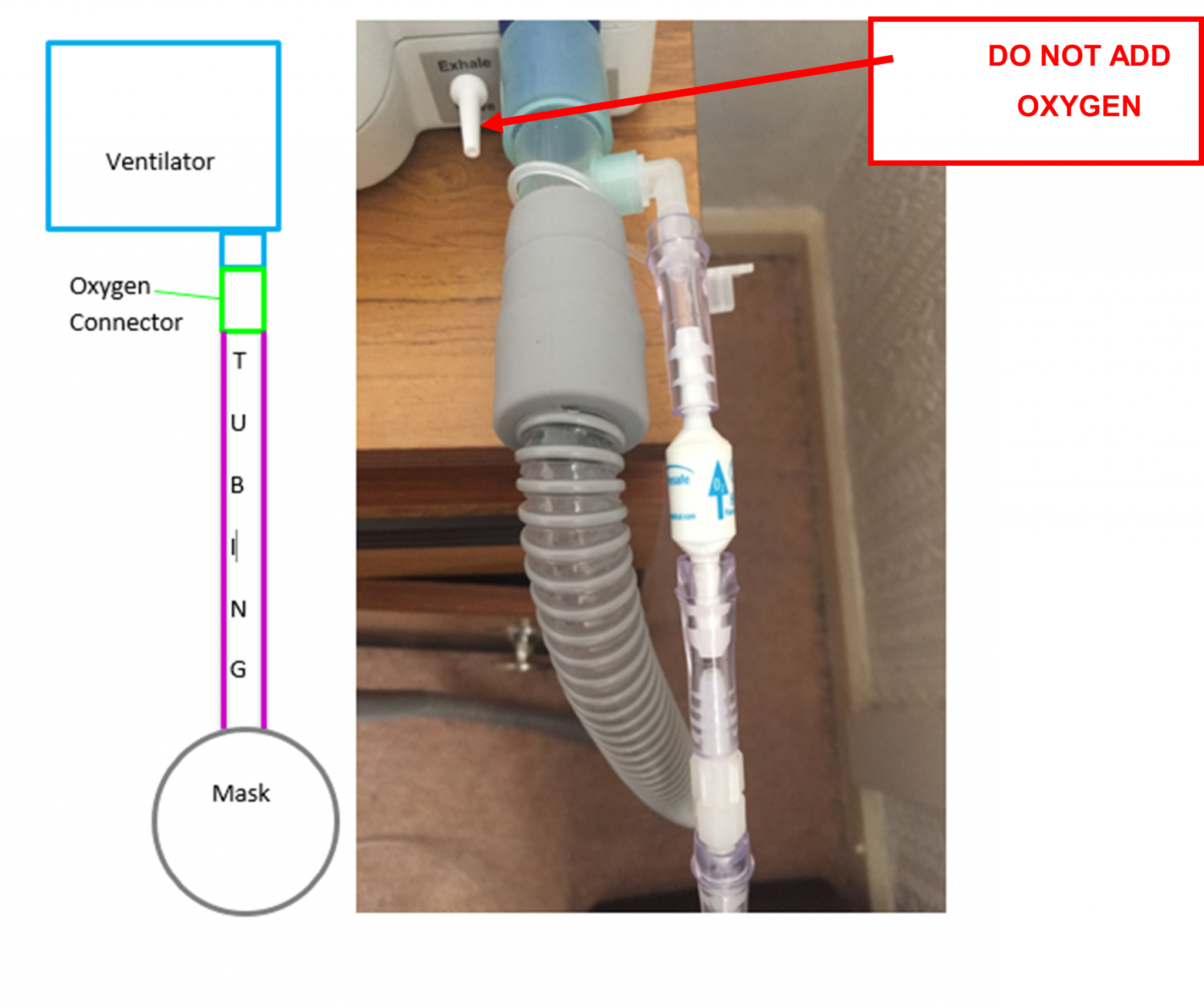 Supplementary oxygen and the NIPPY 3+ ventilator - Newcastle Hospitals ...