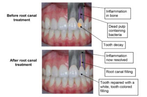 Surgical endodontic/root canal treatment - Newcastle Hospitals NHS ...