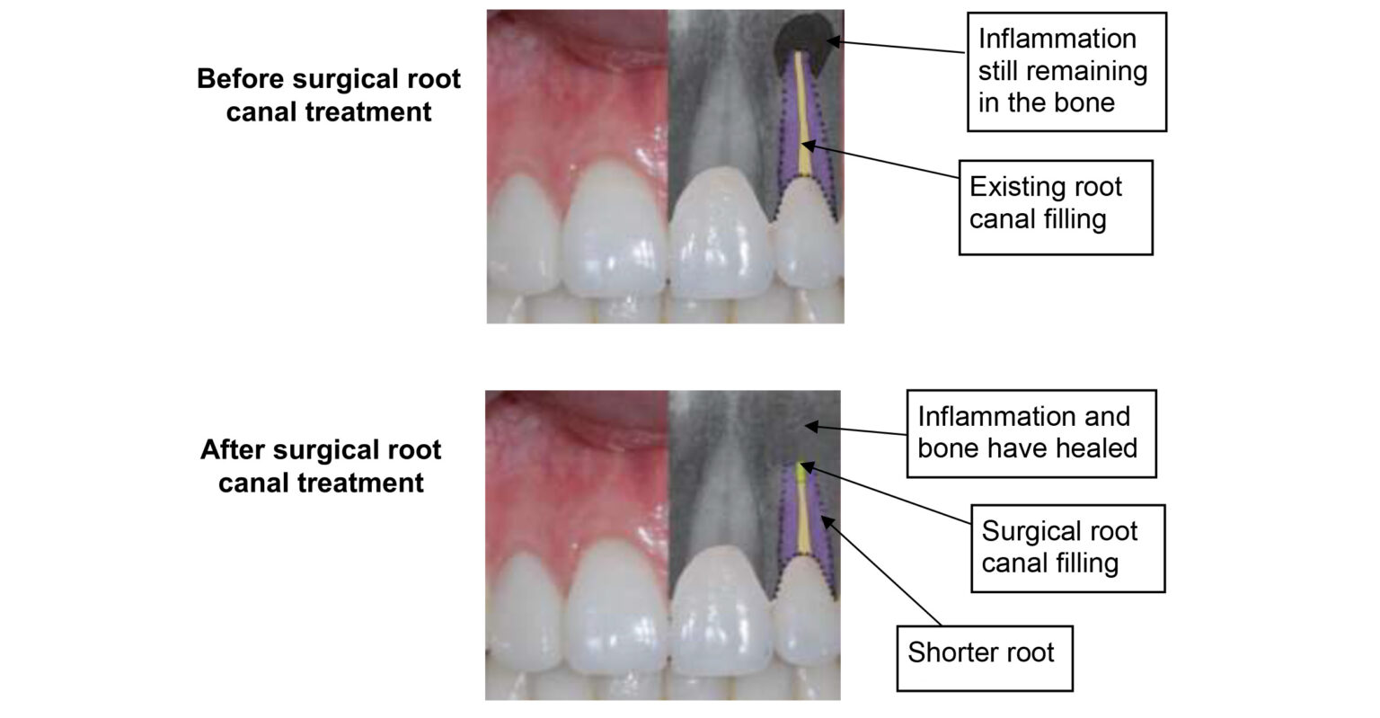 Surgical endodontic/root canal treatment - Newcastle Hospitals NHS ...
