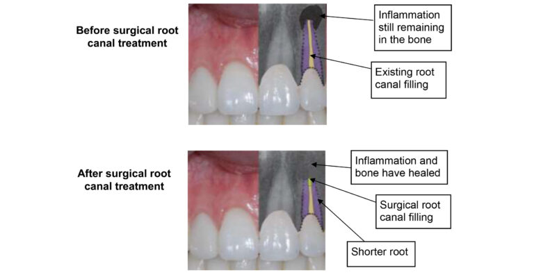 Surgical endodontic/root canal treatment - Newcastle Hospitals NHS ...
