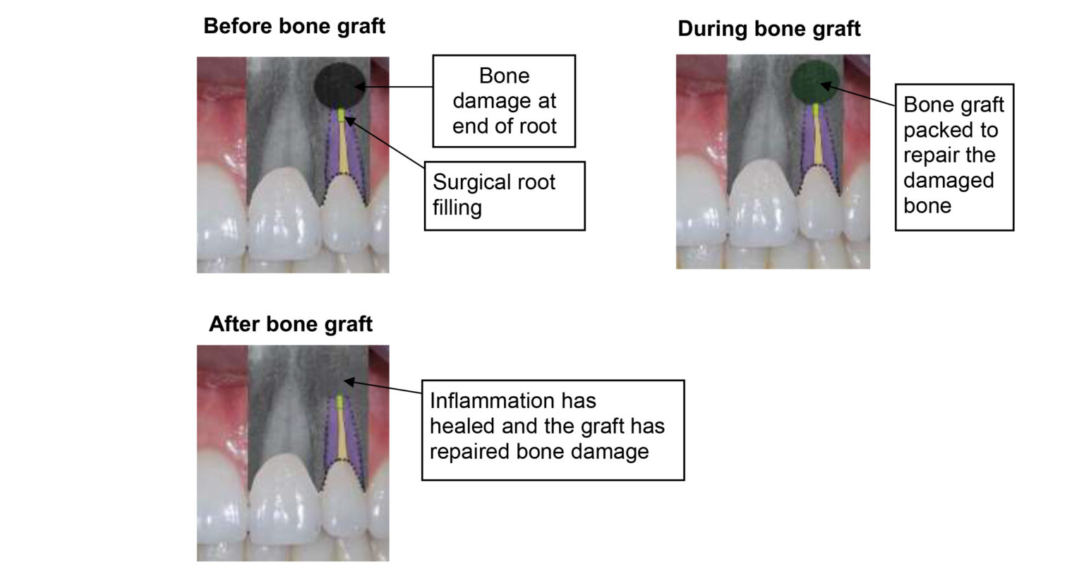 Surgical endodontic/root canal treatment - Newcastle Hospitals NHS ...