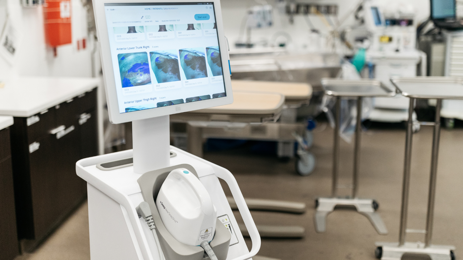 'World first' as Newcastle uses AI to predict how burns will heal ...