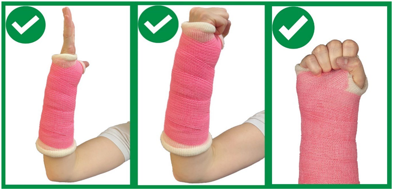 Instructions following application of a cast or splint to your wrist ...